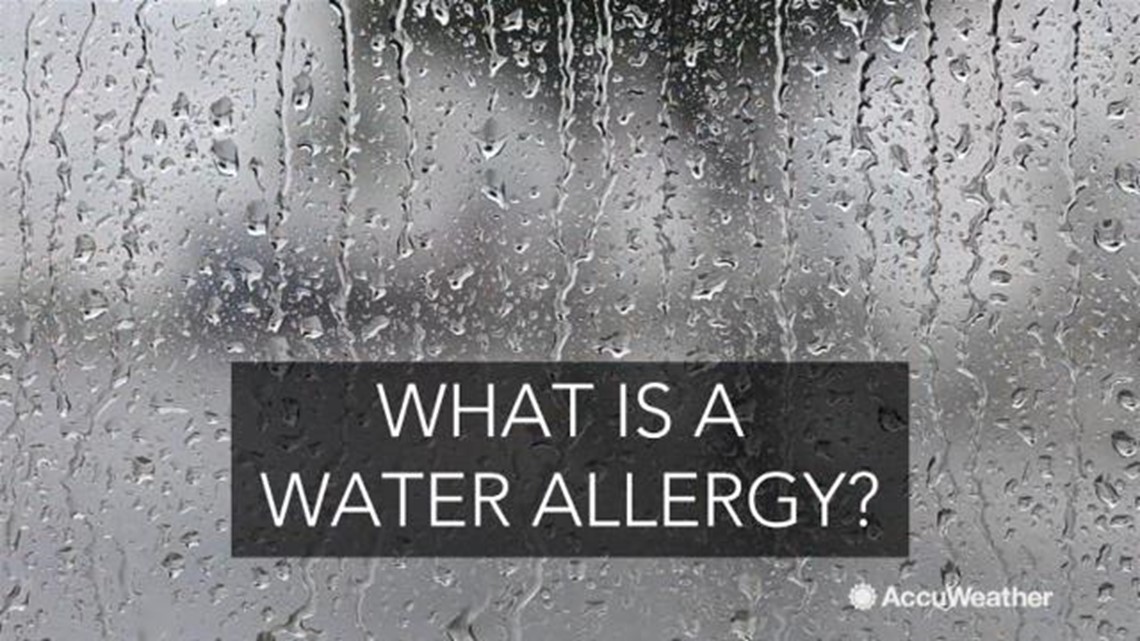 What is a water allergy? | king5.com
