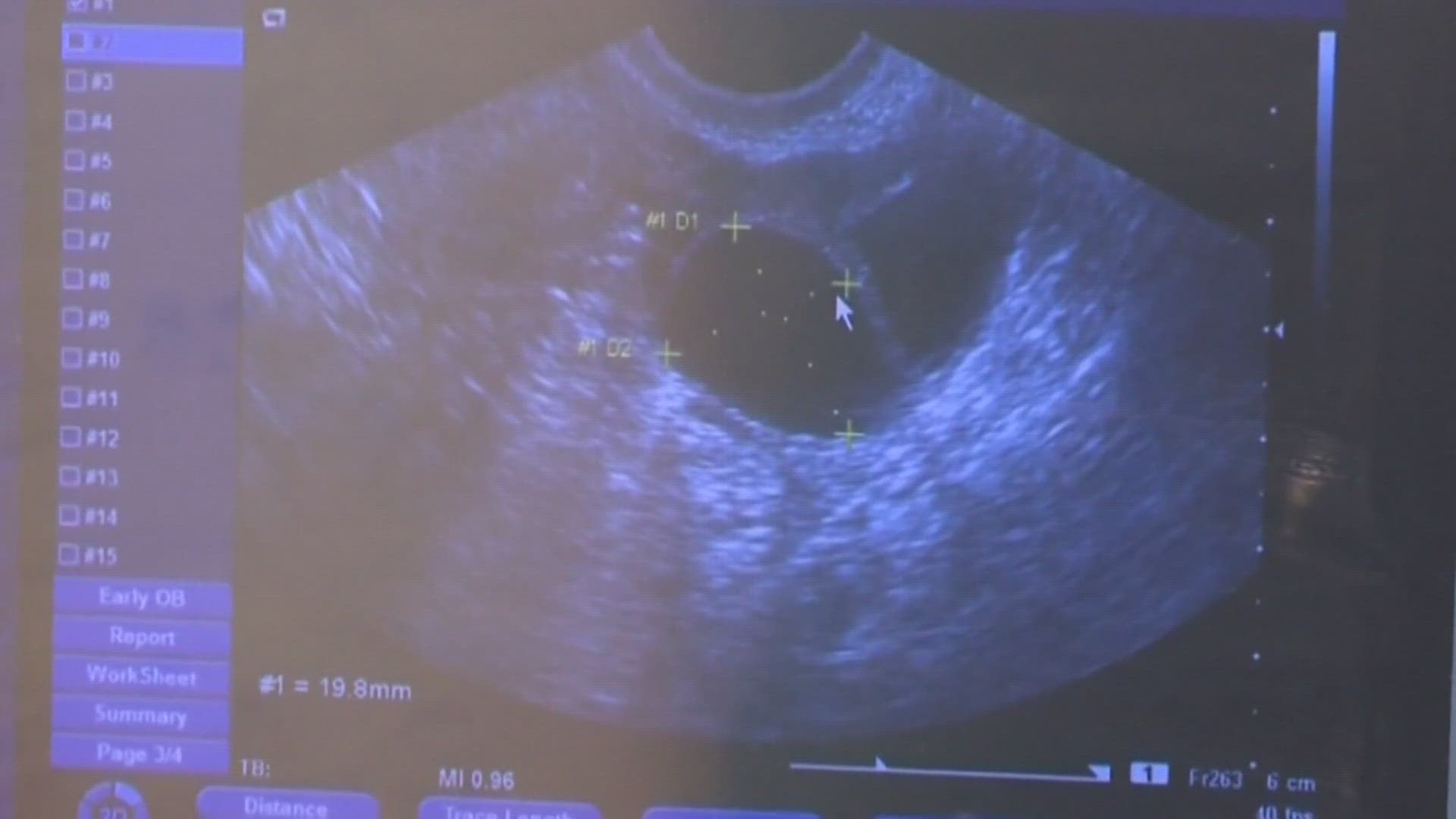 Newborn syphilis cases soared in 2022; up tenfold in past decade ...