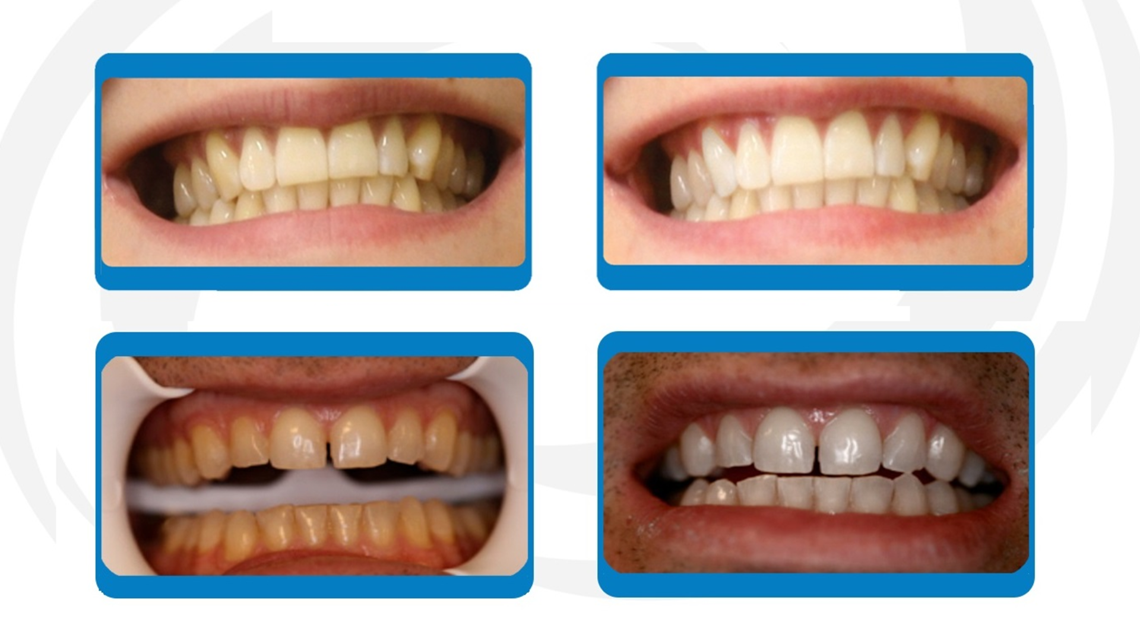 Power Swabs is a quick and easy way to whiten your teeth | king5.com