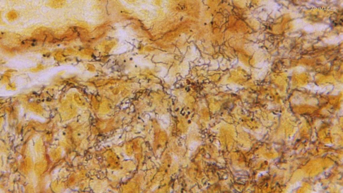 Syphilis cases on the rise in King County | king5.com