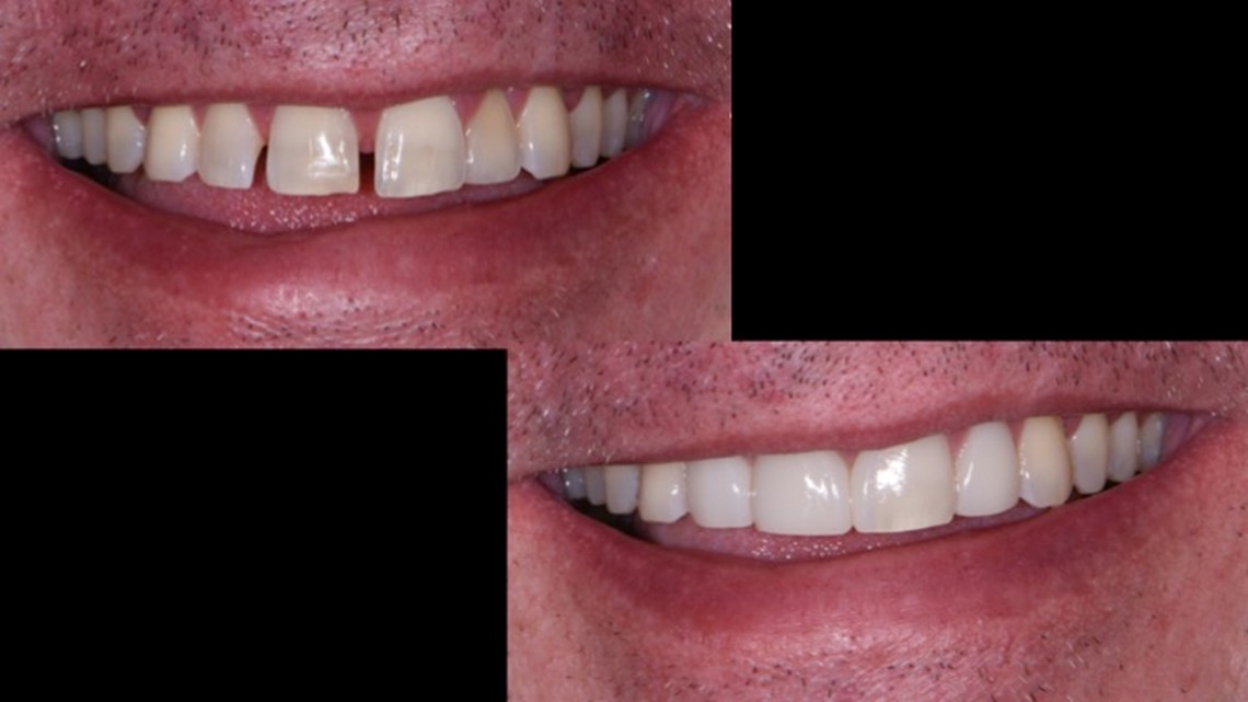 The innovative new Bioclear Method is non destructive to underlying ...