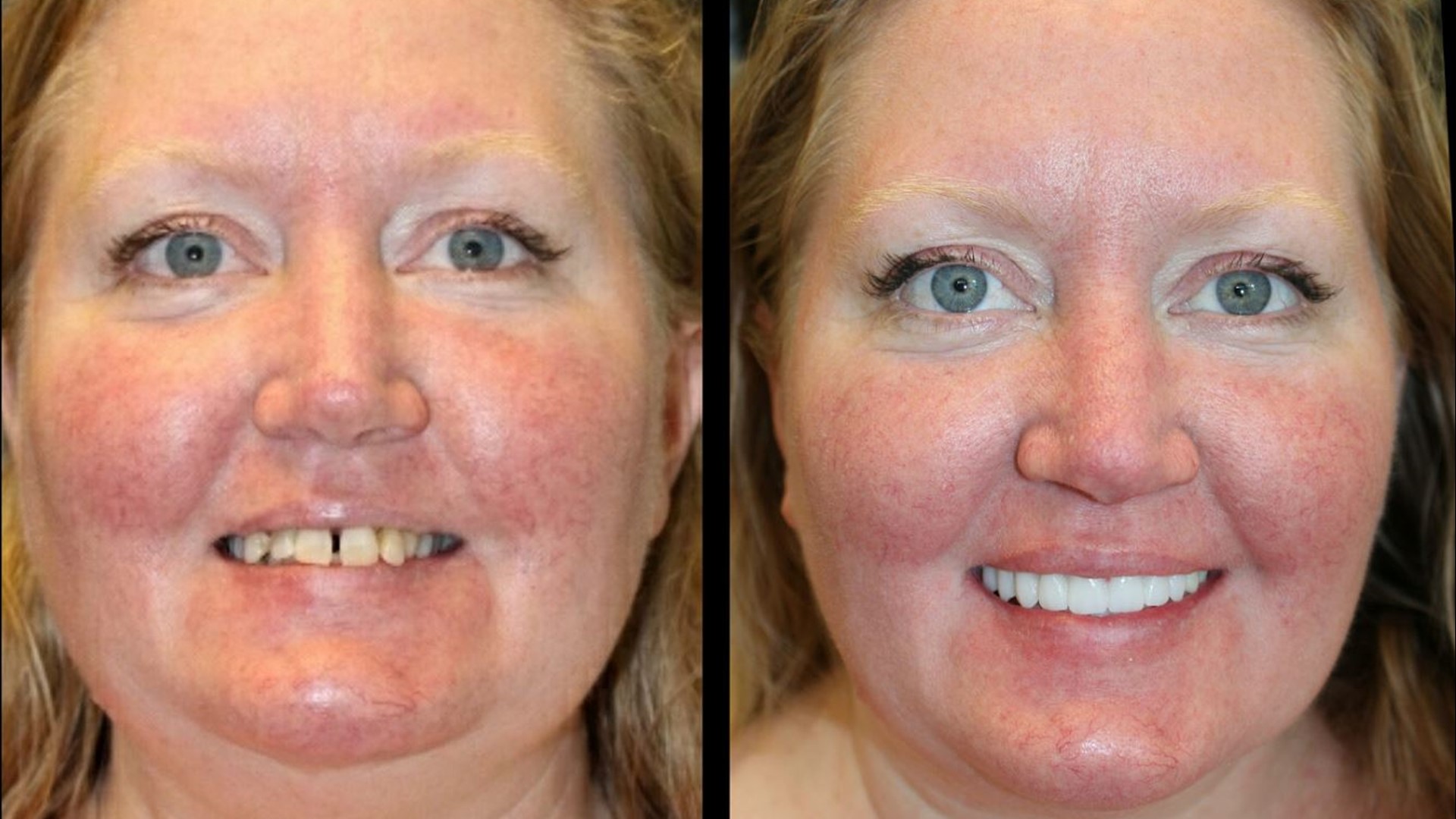 This unique procedure can give people radiant new smiles that last a ...