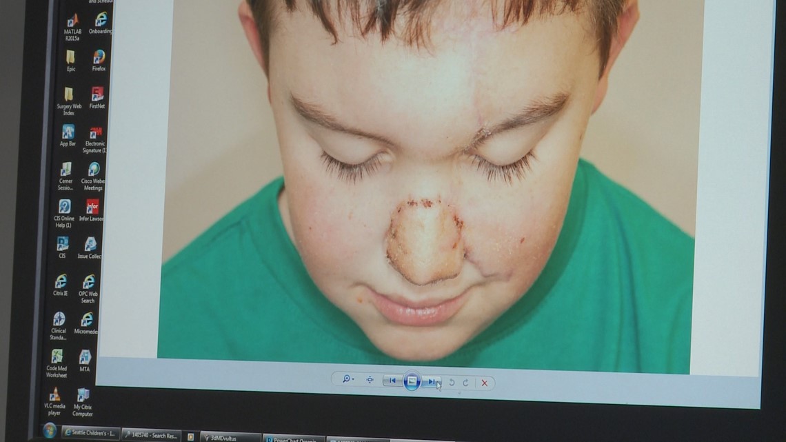 Seattle Children's doctors rebuild boy's nose after dog bite | king5.com