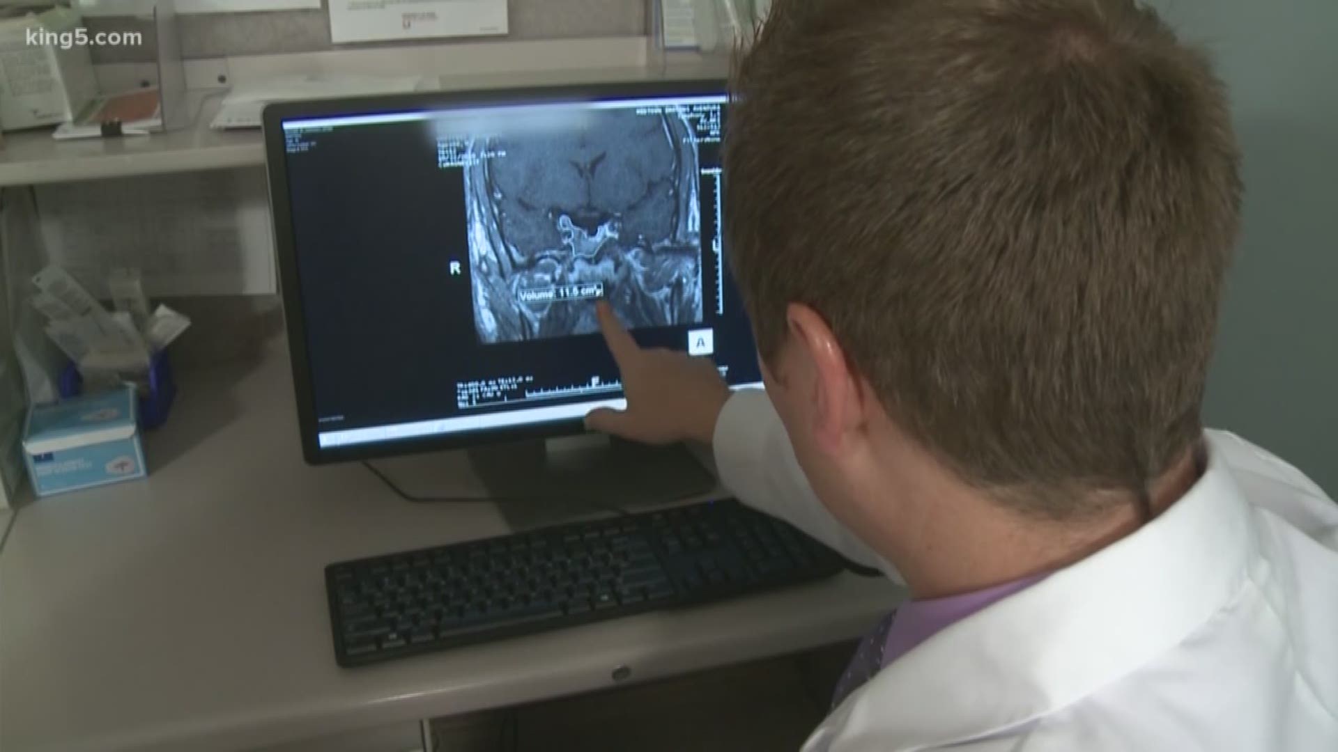 Acromegaly causes irregular body growth | king5.com