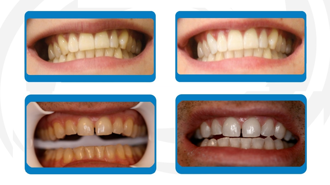 Quick and easy teeth whitening with Power Swabs | king5.com