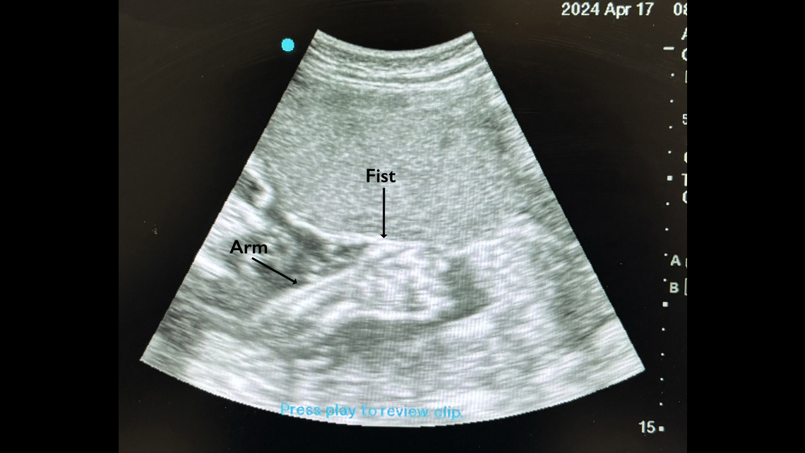 Ultrasound photos of Woodland Park Zoo gorilla Akenji | king5.com