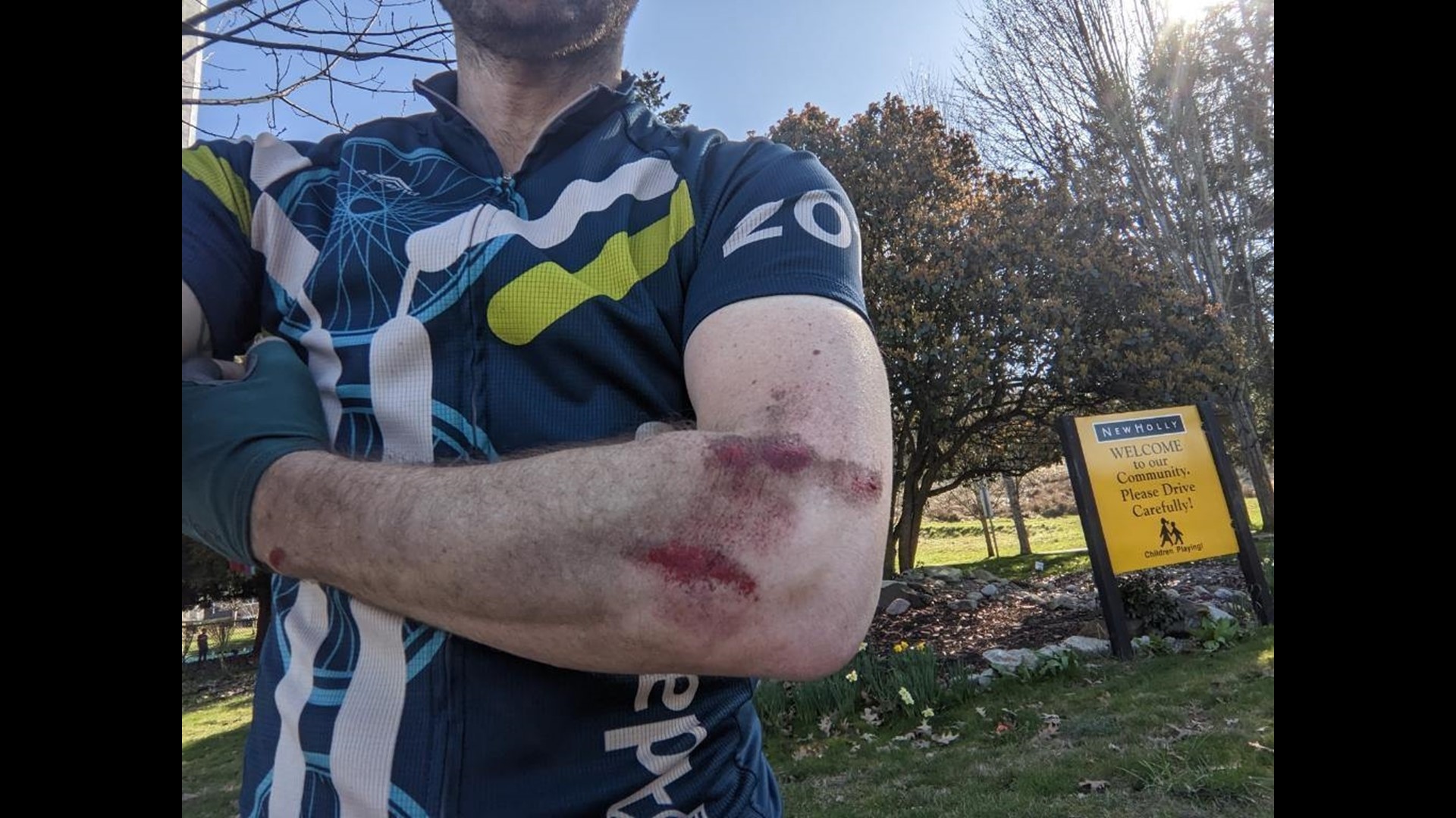 Seattle cyclist warning others after he was struck by an inattentive ...