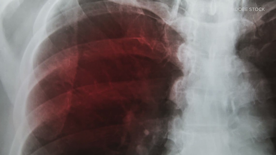 Pierce County woman who refused treatment for her tuberculosis now ...